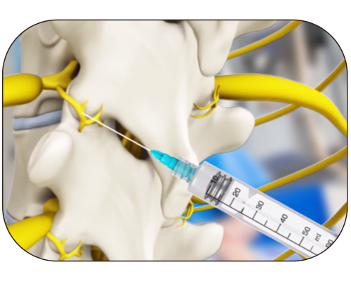 Targeted Nerve Blocks - Dr. Murali's Pain Centre