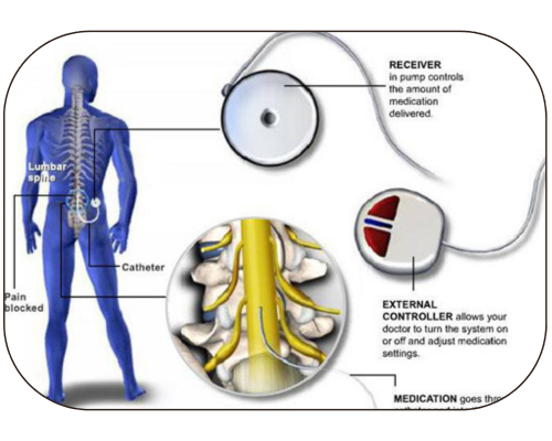 Inthratecal Morphin Pump - Dr. Murali's Pain Centre